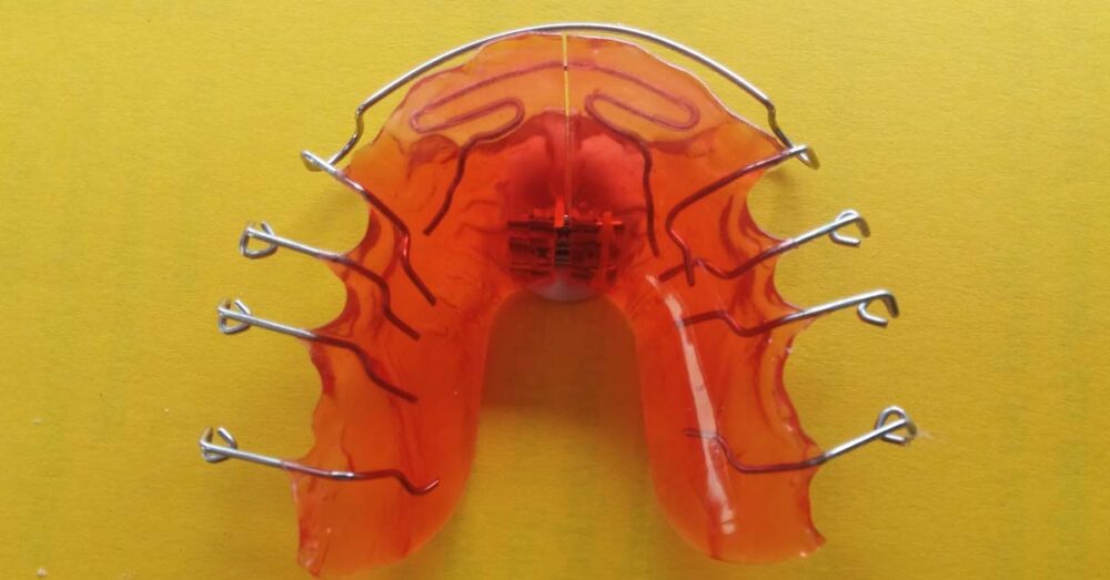 Apparecchi ortodontici - Studio Ortodontico a Segrate